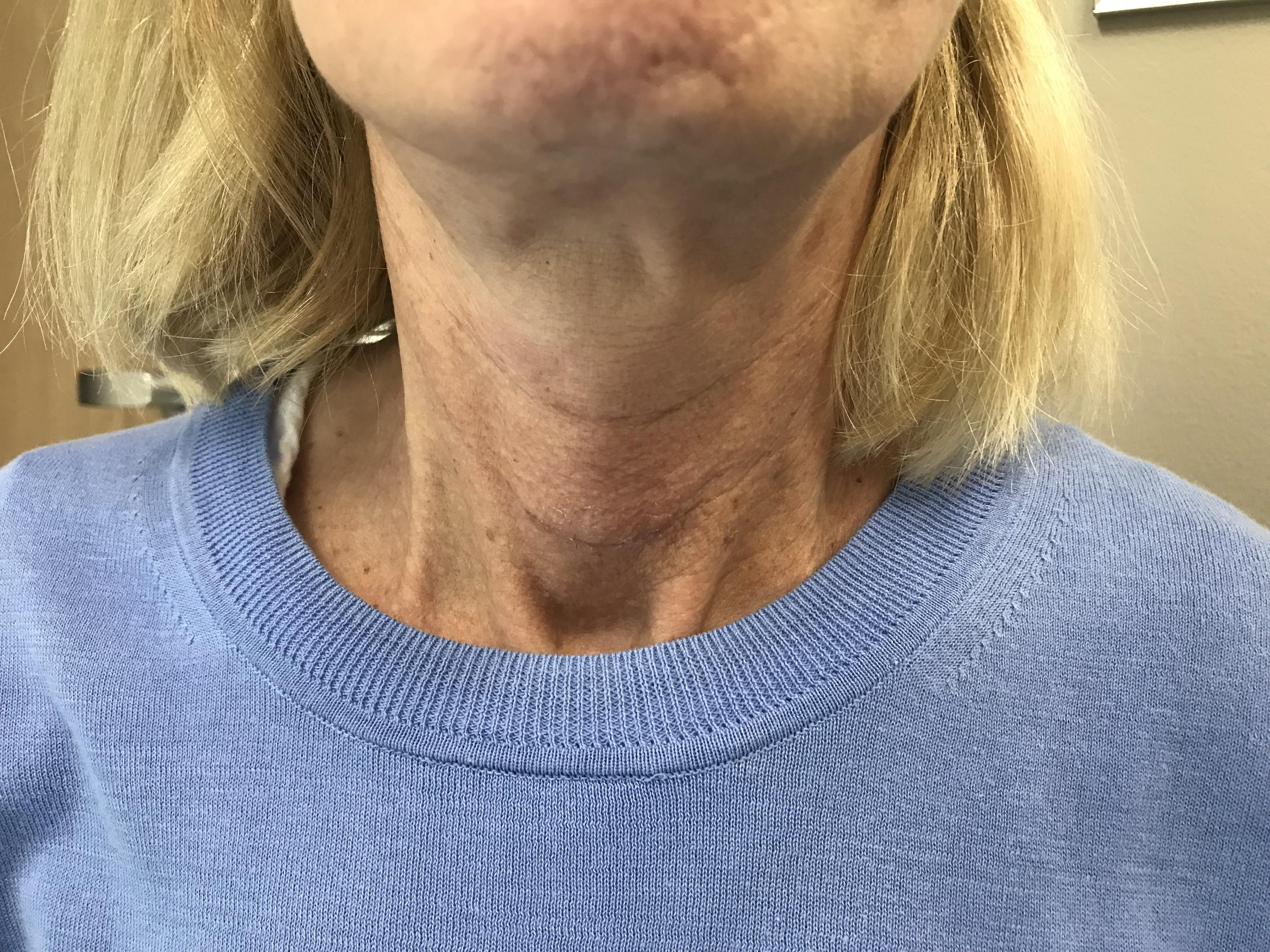 Scar Gallery | Avital Harari, MD, MBA, MSc, FACS — ENDOCRINE SURGEON